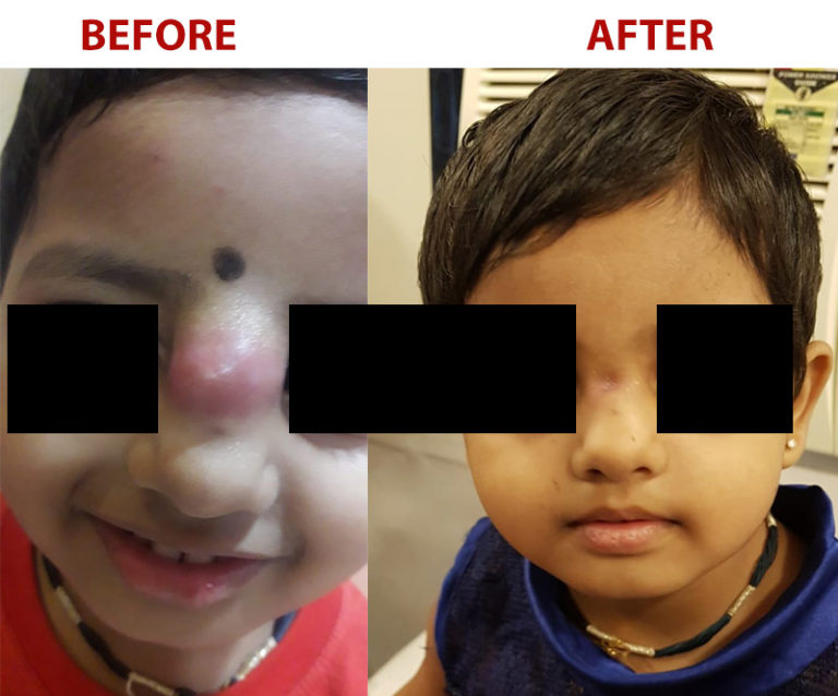 Everything you need to know about Dermoid cyst – Bombay Cosmetic Clinic